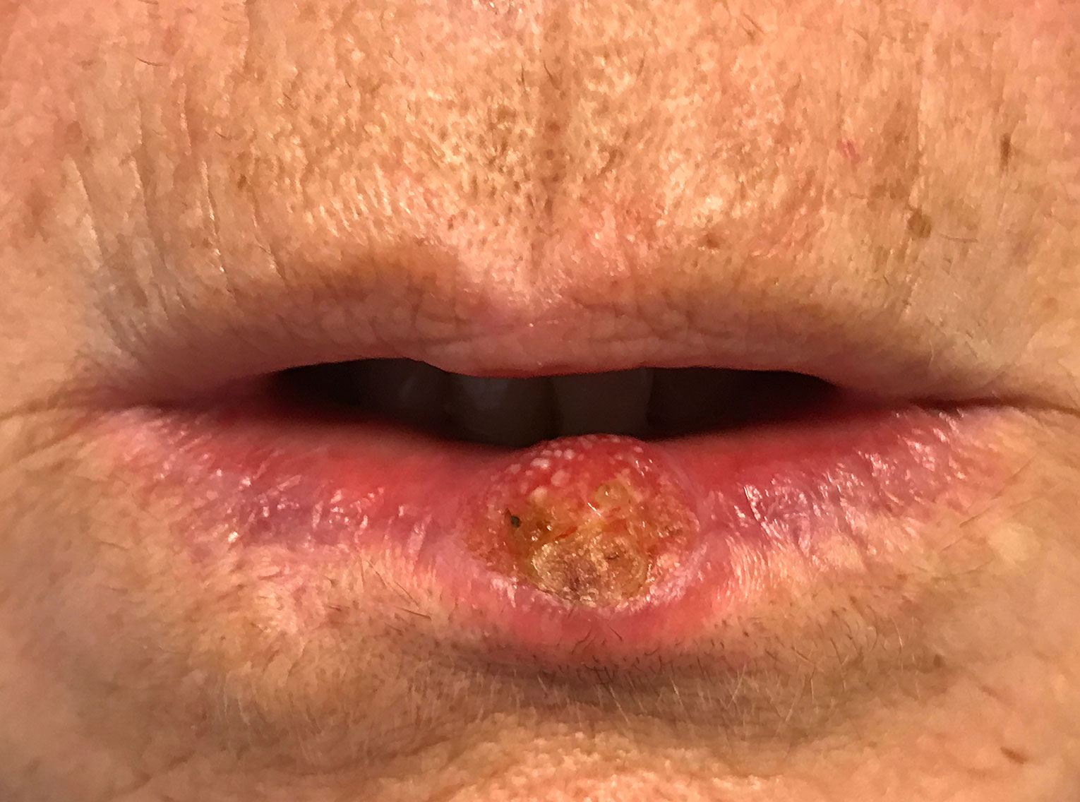 Dermoscopy Of A Squamous Cell Carcinoma Of The Lower Lip Showing Dermoscopy Of A Squamous Cell Carcinoma Of The Lower Lip Showing