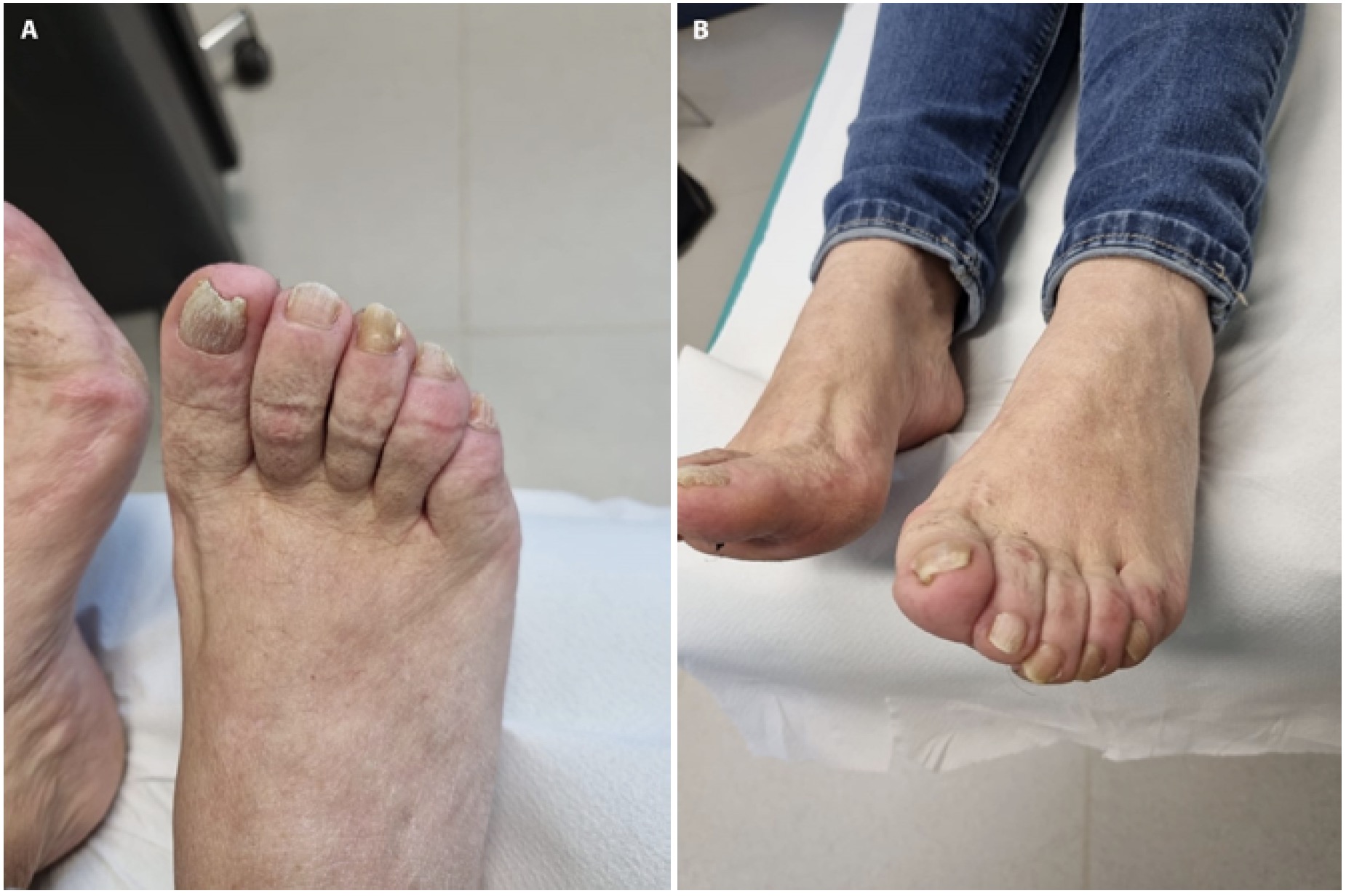 Acrodermatitis Continua Of Hallopeau